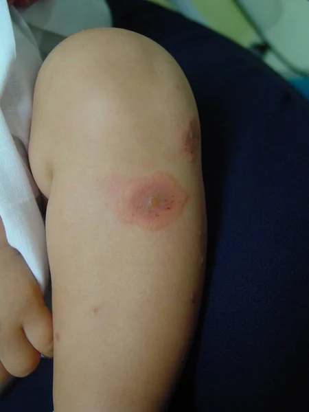 Ulcère cutané images libres de droit, photos de Ulcère cutané ...