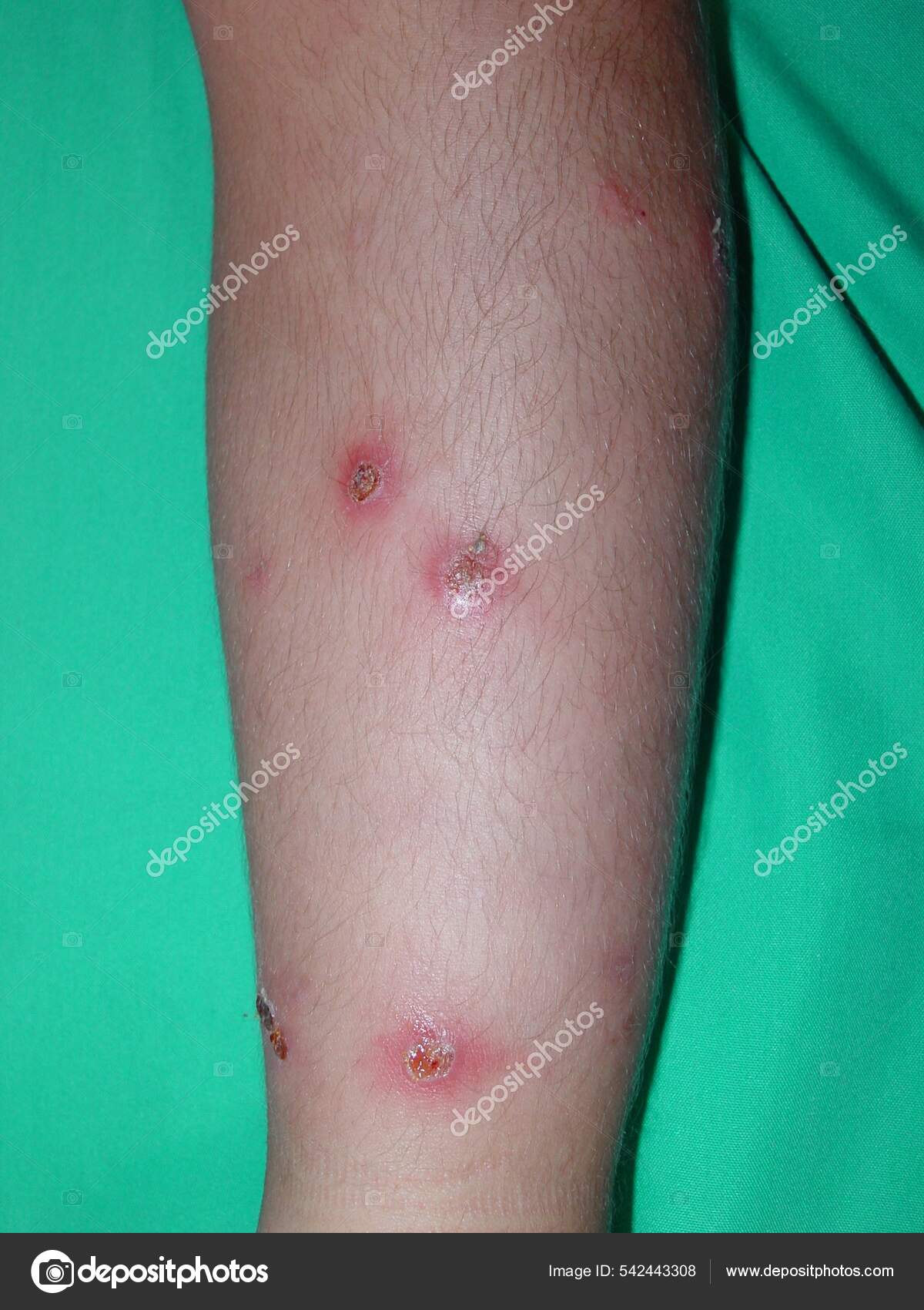 Prurigo Una Dermatosis Papular Vesicular Muy Pruriginosa Que Produce ...