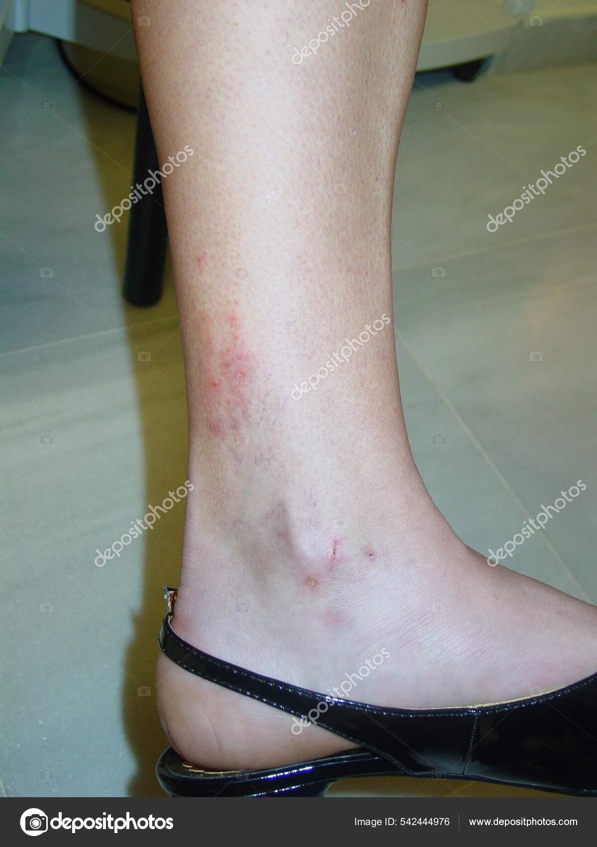 Prurigo Una Dermatosis Papular Vesicular Muy Pruriginosa Que Produce ...