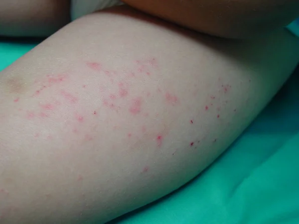 Dermatite enfant images libres de droit, photos de Dermatite enfant ...