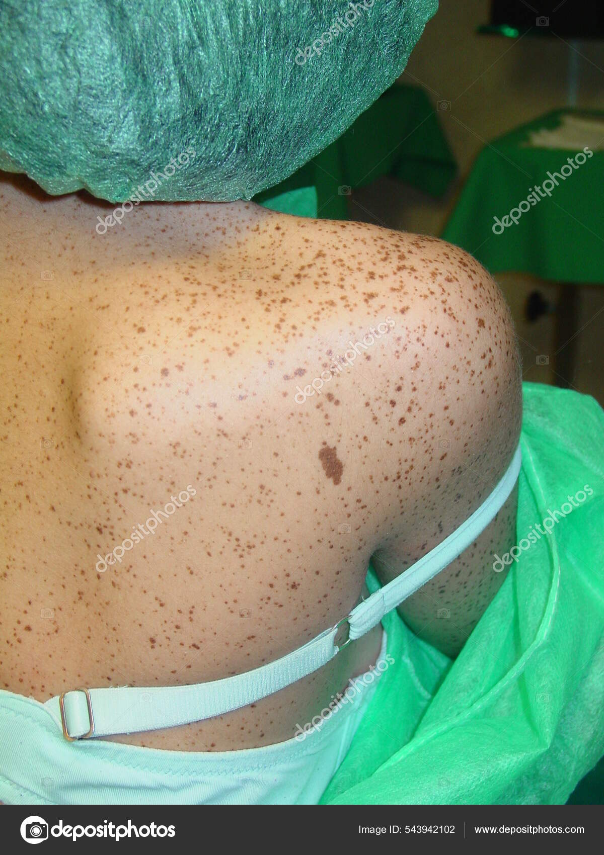 Leopard Syndrome Complex Genetic Malformations Autosomal Dominant ...