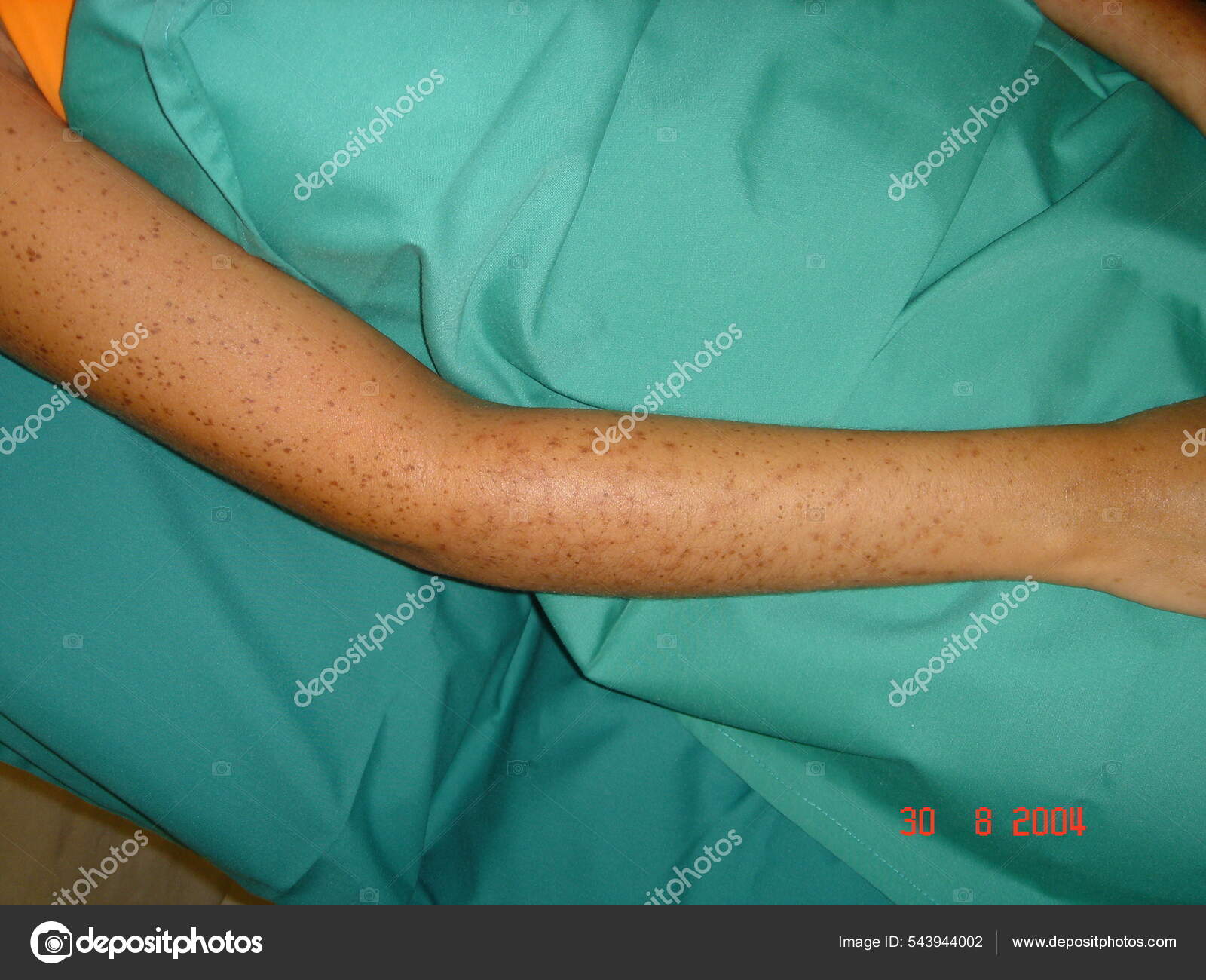 Leopard Syndrome Complex Genetic Malformations Autosomal Dominant ...