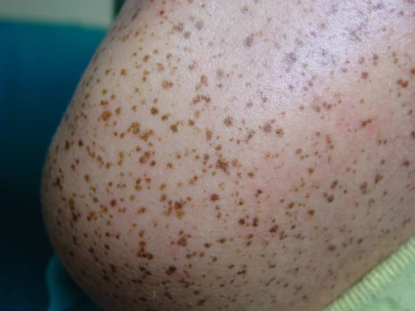 Red rashes and spots images libres de droit, photos de Red rashes and ...