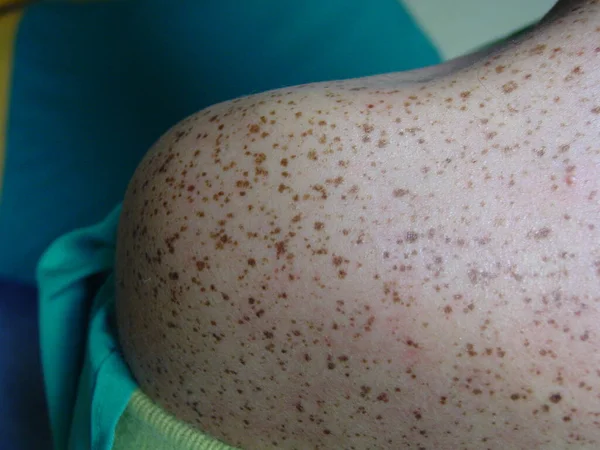 Red rashes and spots images libres de droit, photos de Red rashes and ...