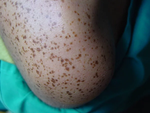 Actinic keratosis Stock Photos, Royalty Free Actinic keratosis Images ...