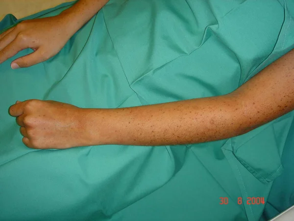 Erythema arm Stock Photos, Royalty Free Erythema arm Images | Depositphotos