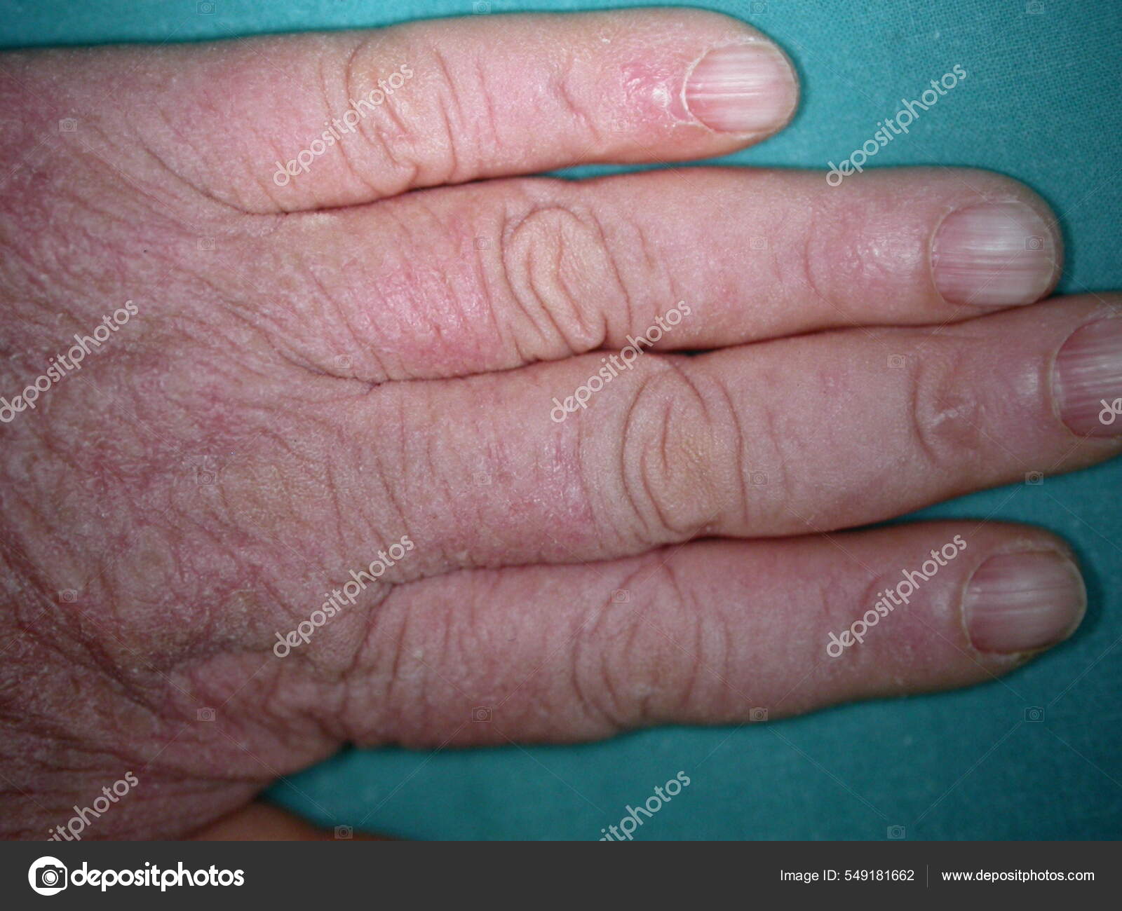 Bazex Syndrome Paraneoplastic Acrokeratosis Psoriasiform Eruption Seen ...