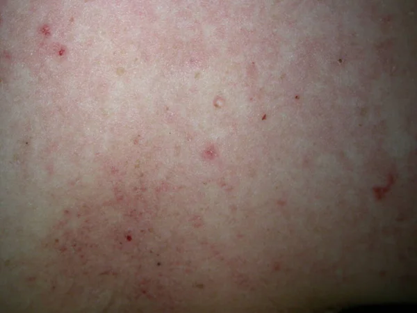 Maladie de peau images libres de droit, photos de Maladie de peau ...