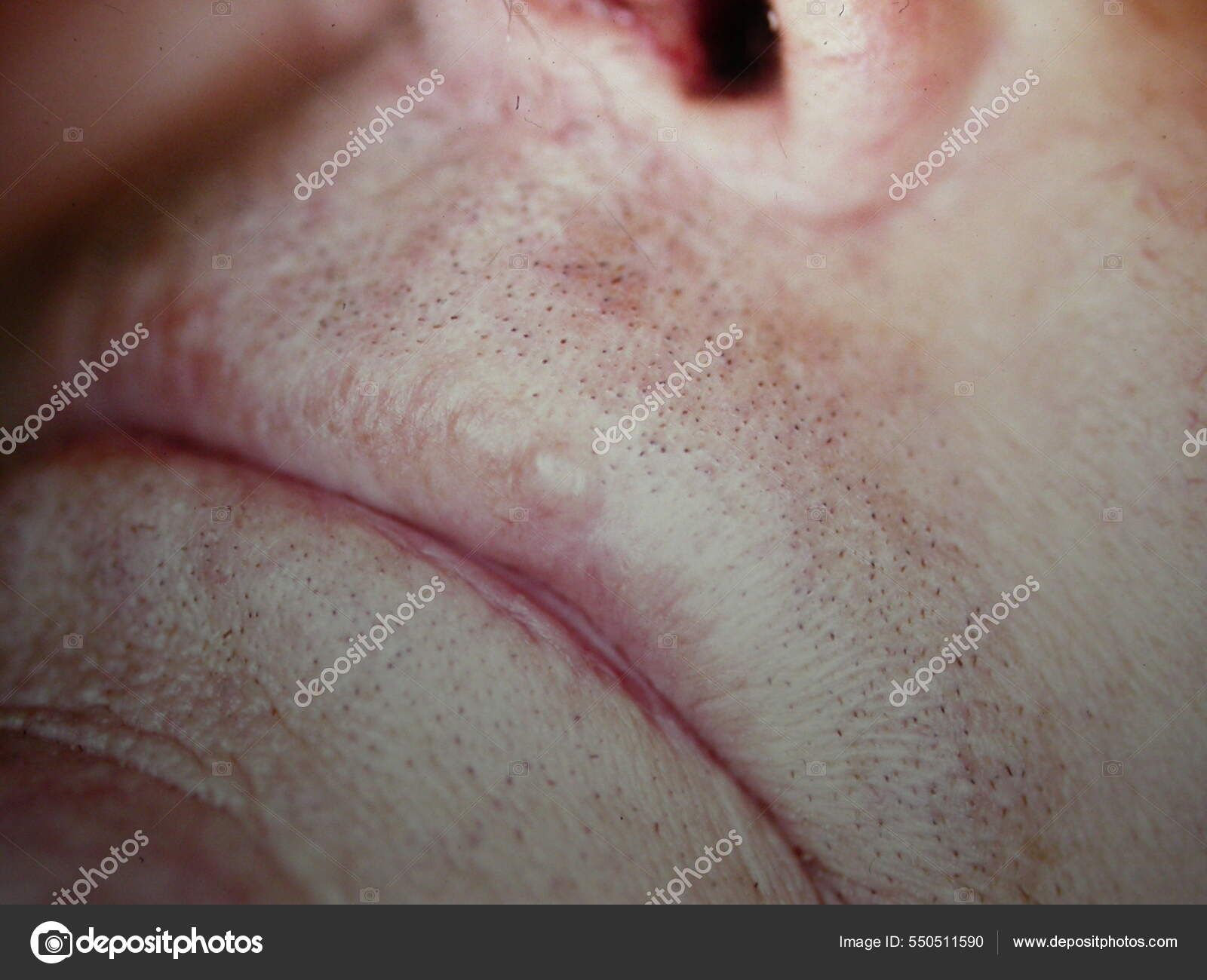 Cryosurgery Procedure Uses Extremely Cold Liquid Instrument Called ...