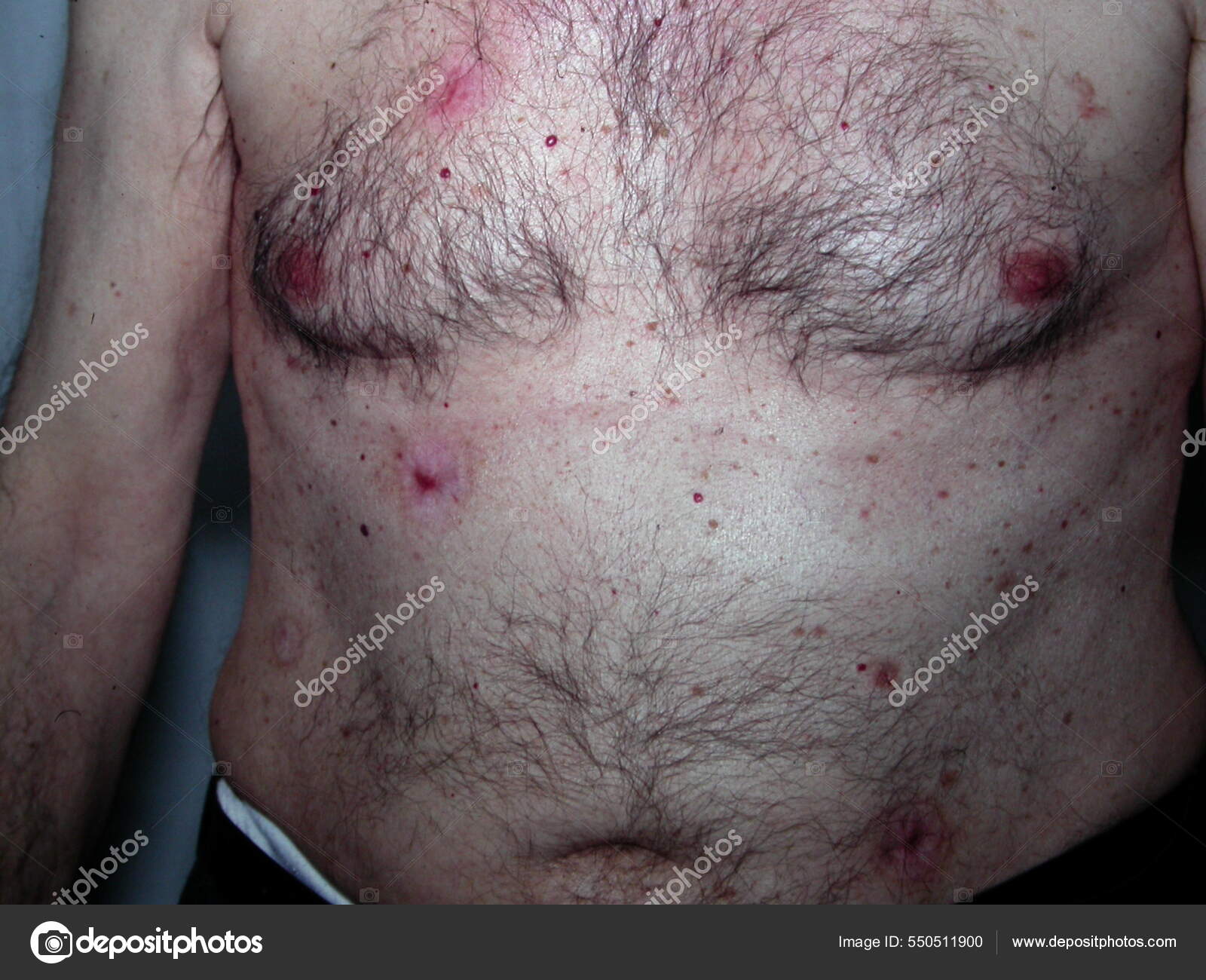 Cryosurgery Procedure Uses Extremely Cold Liquid Instrument Called ...