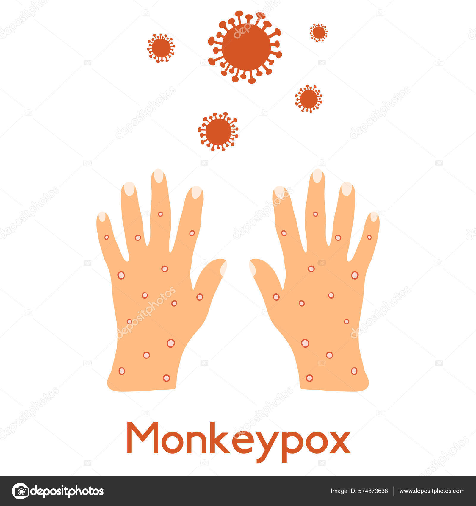Monkeypox Symptoms Hand Skin Rashes Blisters Purulent Formations Skin ...