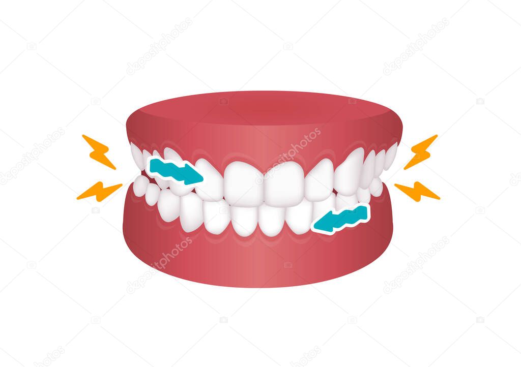 Bruxismo vector ilustración jalá rechinar los dientes 2023