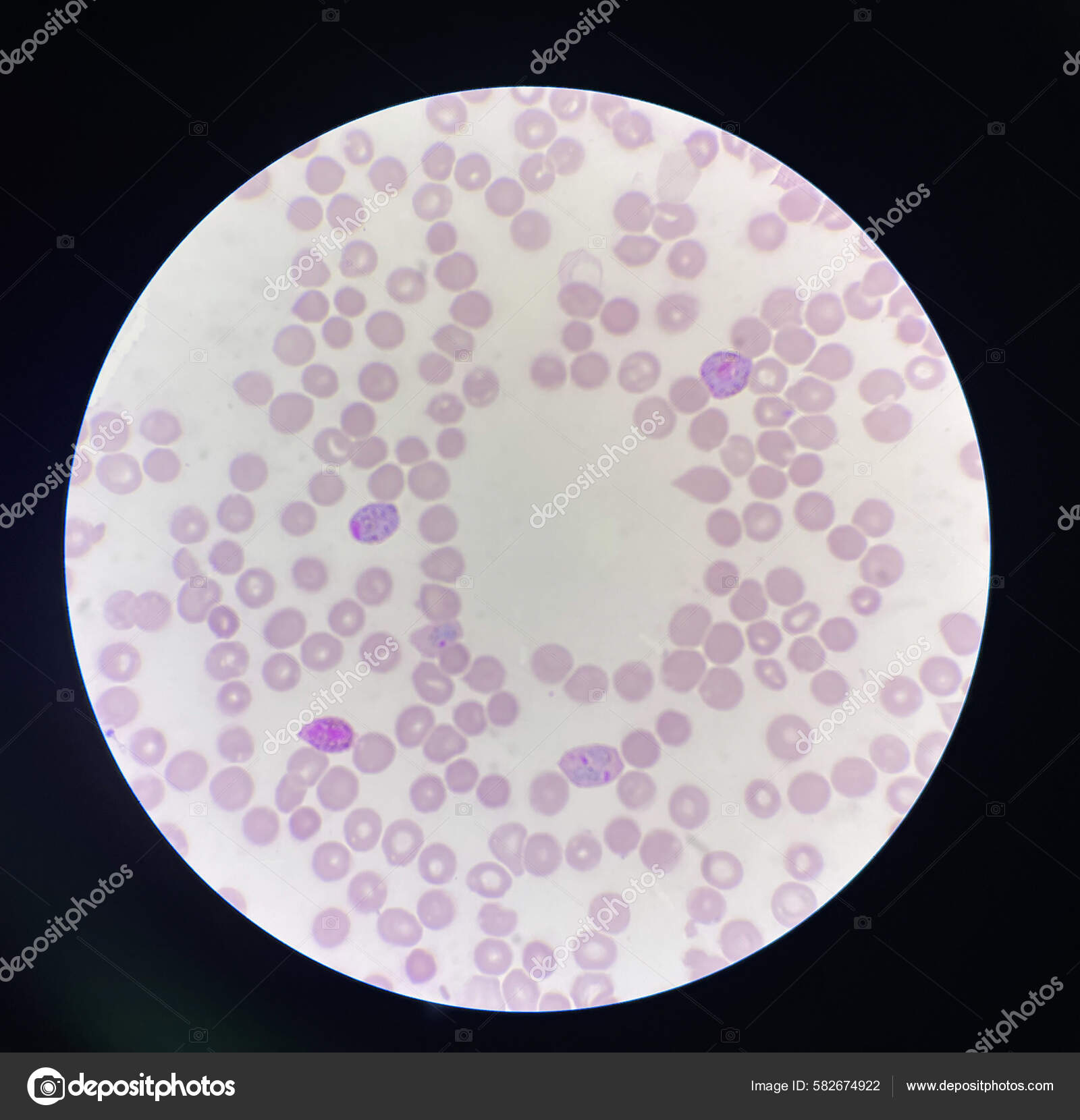 Malaria Blood Parasite Infected Red Blood Cells Laboratory Background ...