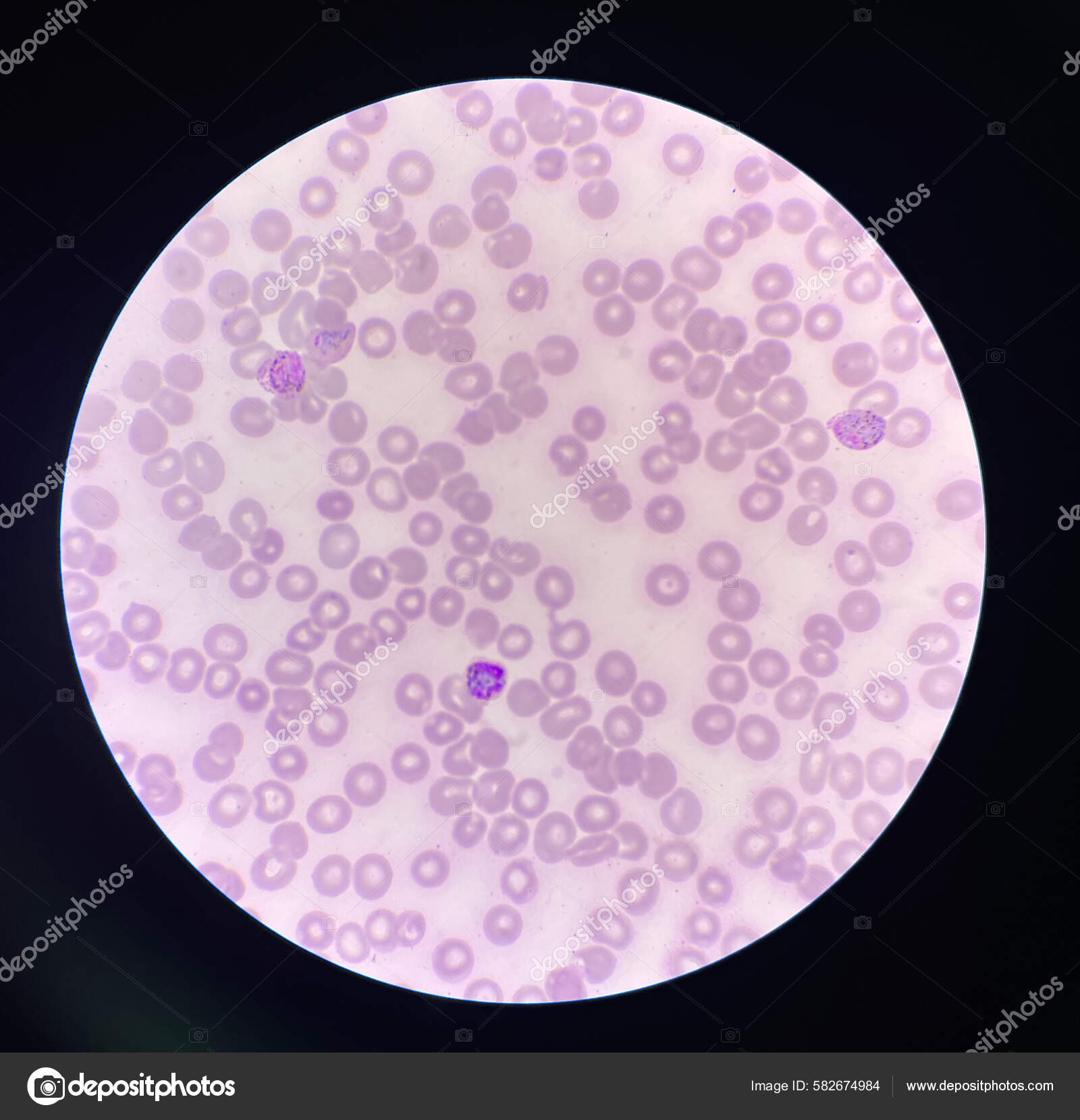 Malaria Blood Parasite Infected Red Blood Cells Laboratory Background ...