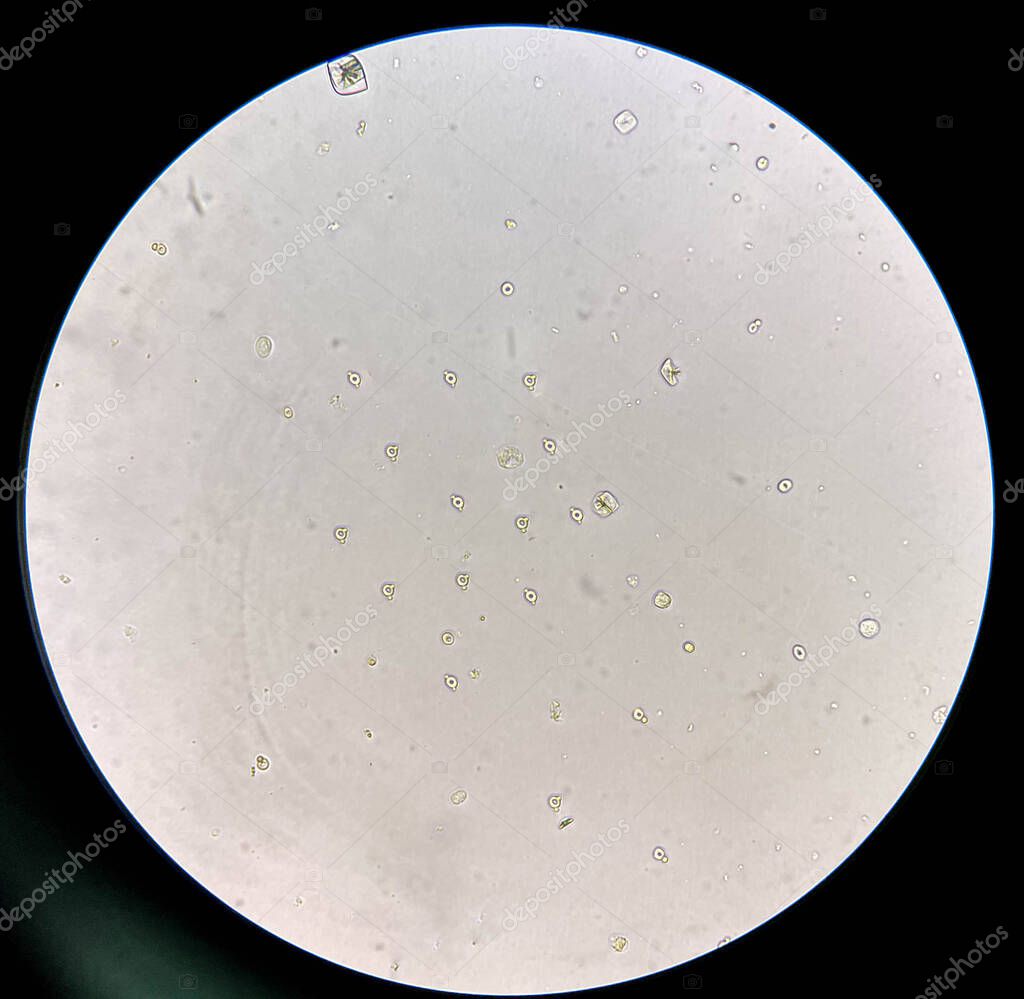 Los glóbulos rojos urinarios dismórficos se han considerado un ...