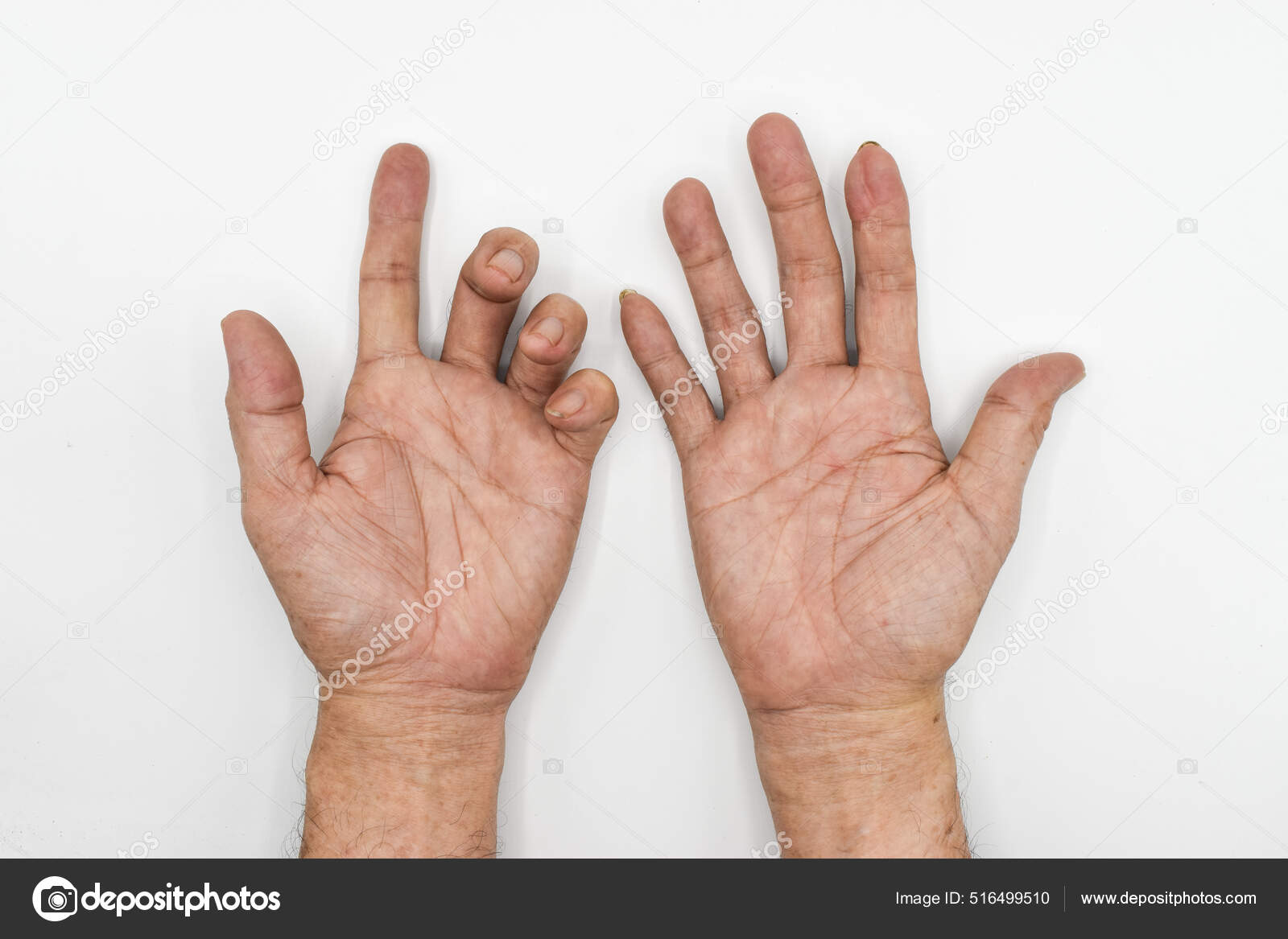 Anatomía De La Mano En Garra