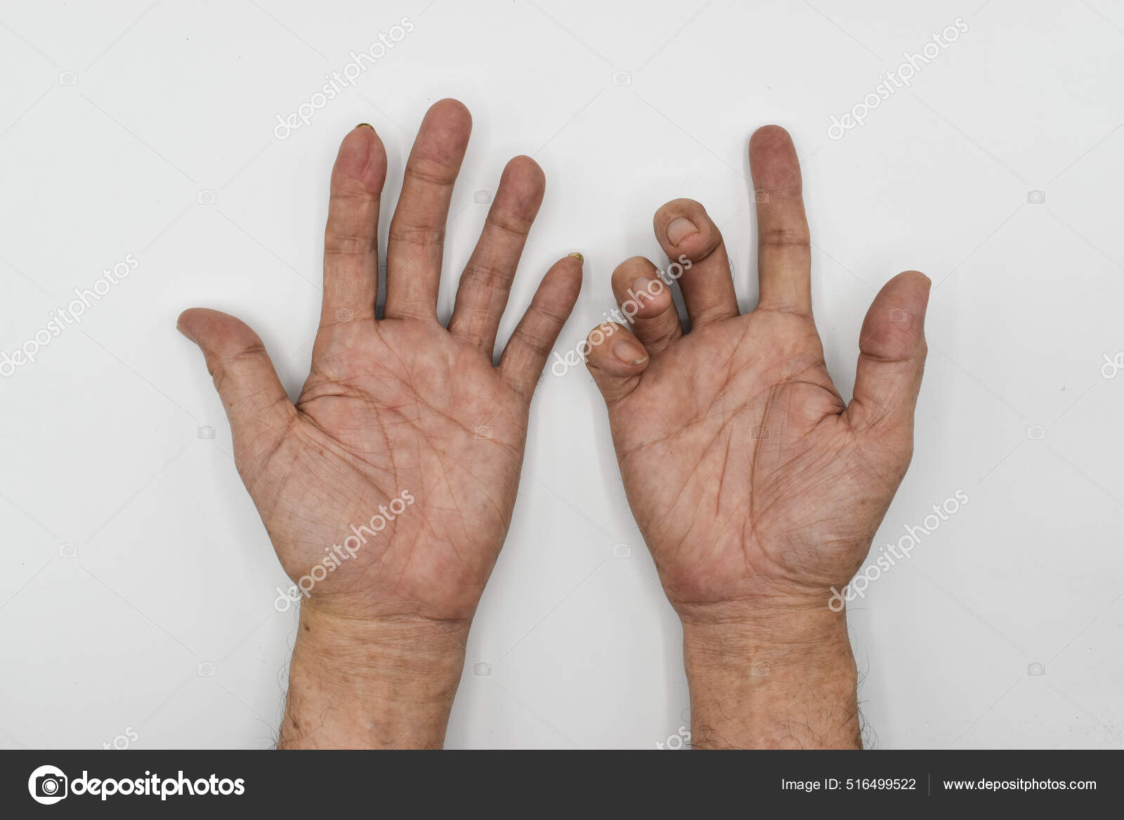 Nervio Cubital Mano En Garra