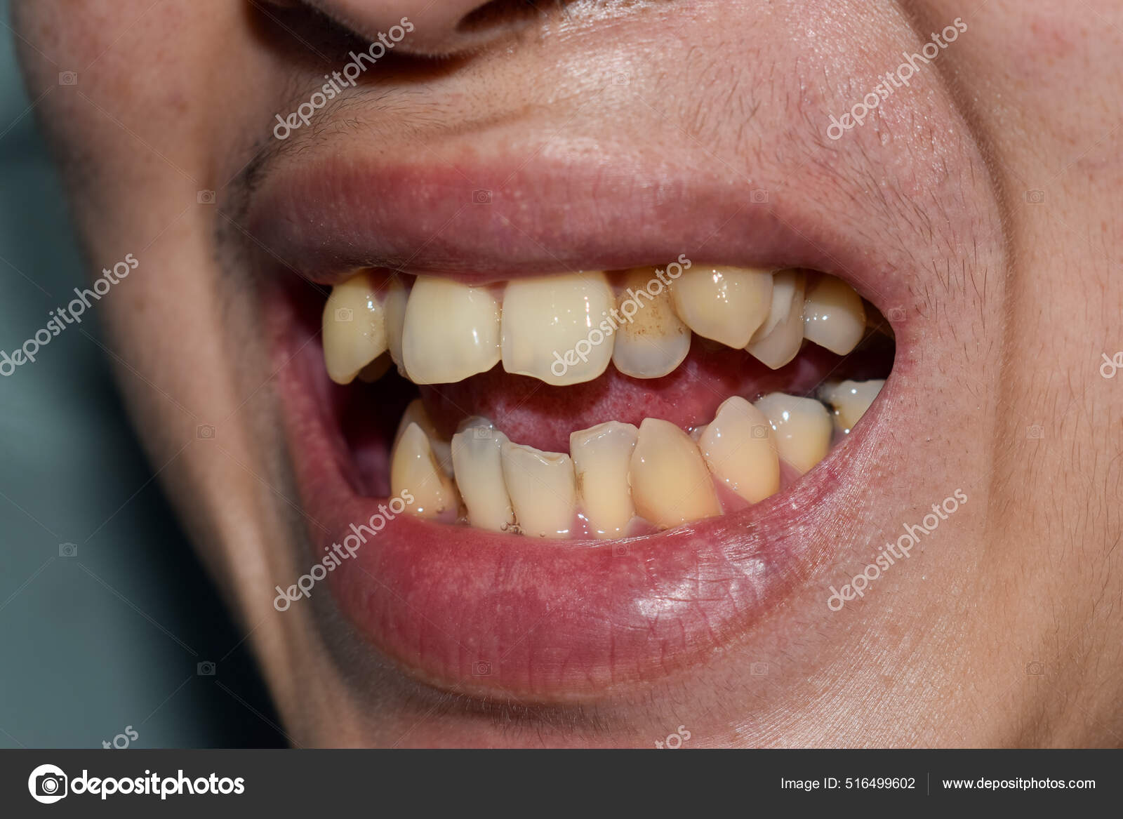 Stacked Overlapping Teeth Yellow Stain Asian Man Also Called Crowded ...