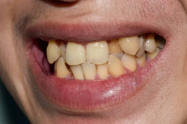 Stacked or overlapping teeth with yellow stain of Asian man. Also ...
