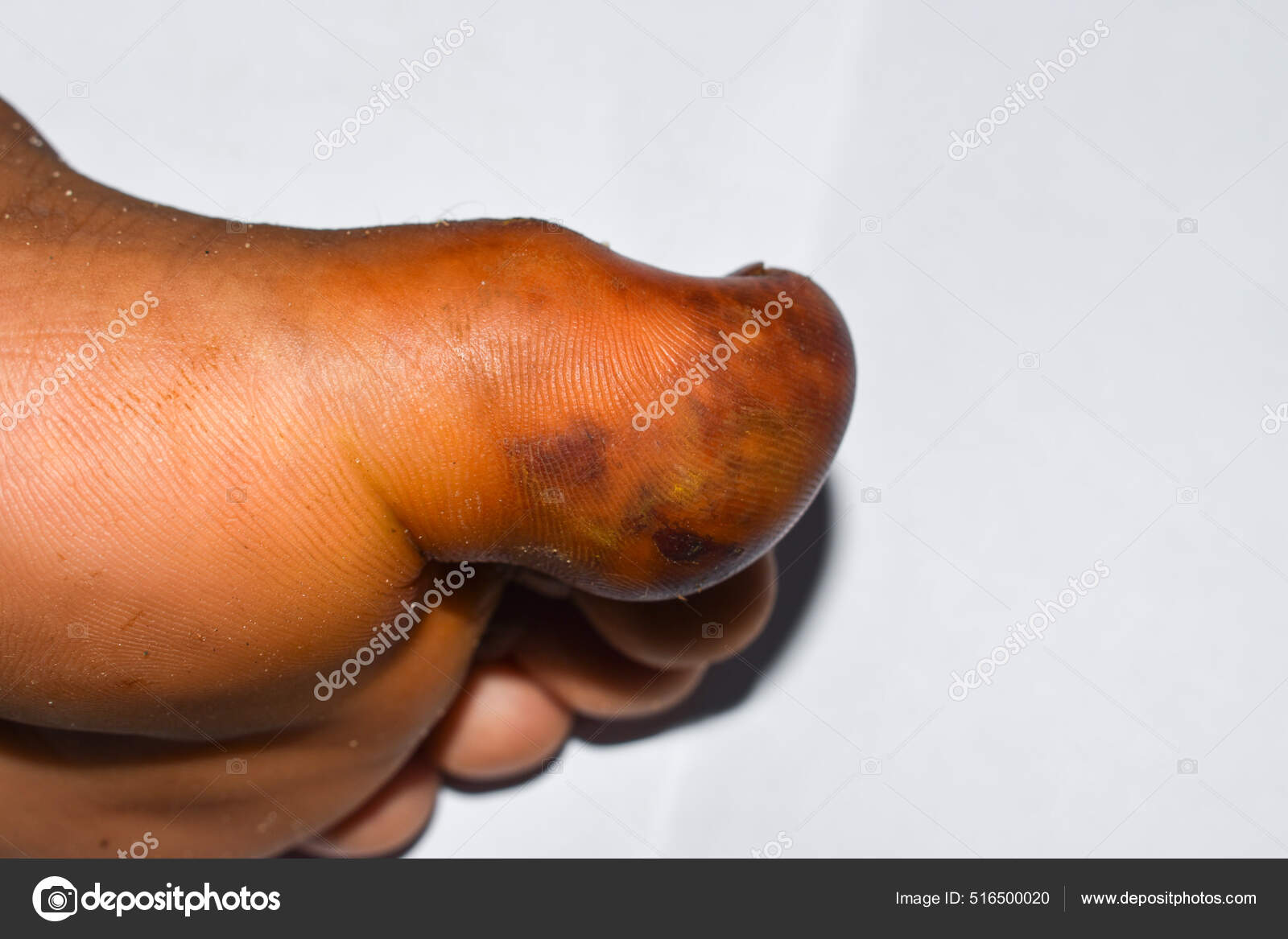 Abscess Surrounding Cellulitis Staphylococcal Streptococcal Skin ...