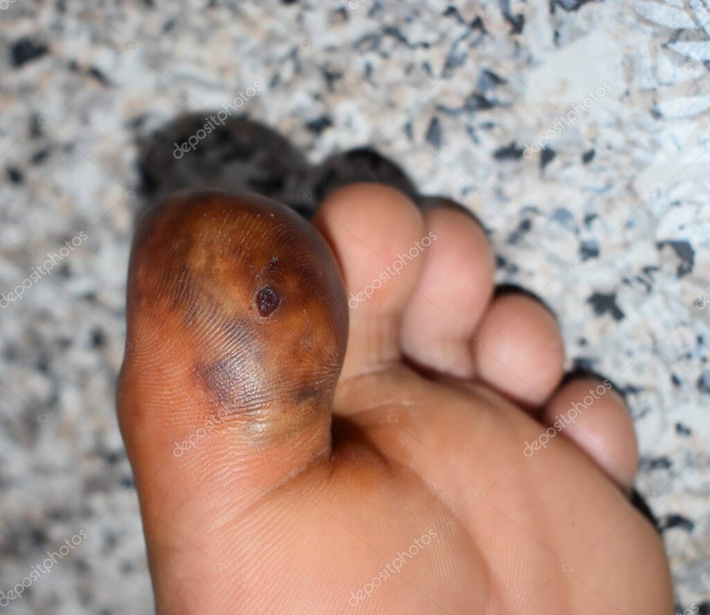 Absceso con celulitis circundante o infección estafilocócica ...