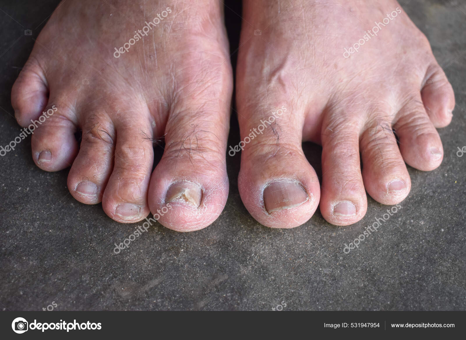 Old Man Feet Concept Dry Foot Skin Aging Stock Photo by ©zaynyinyi ...