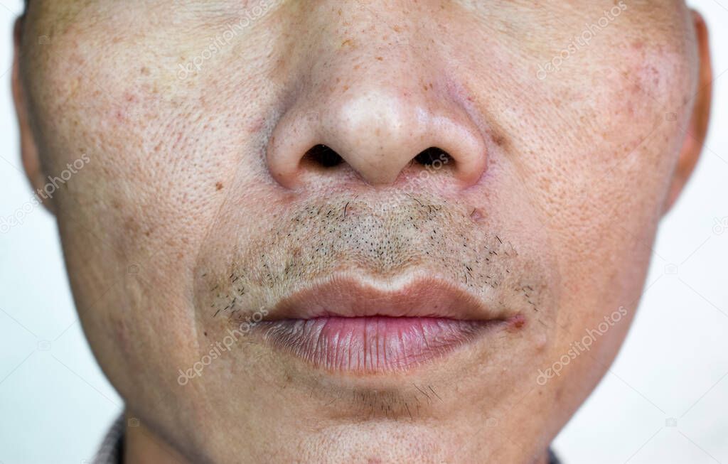 Piel áspera en la cara del sudeste asiático, Myanmar o el hombre adulto ...