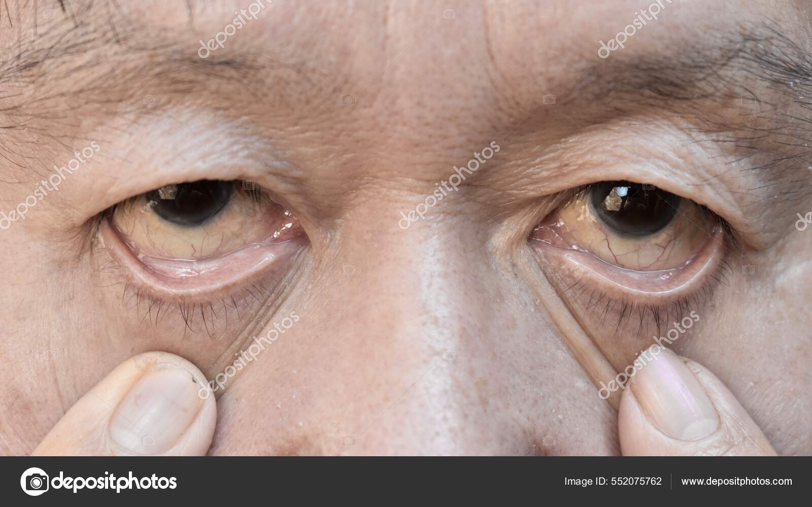 Pale Skin Asian Elderly Man Sign Anemia Pallor Eyelid — Stock Photo ...