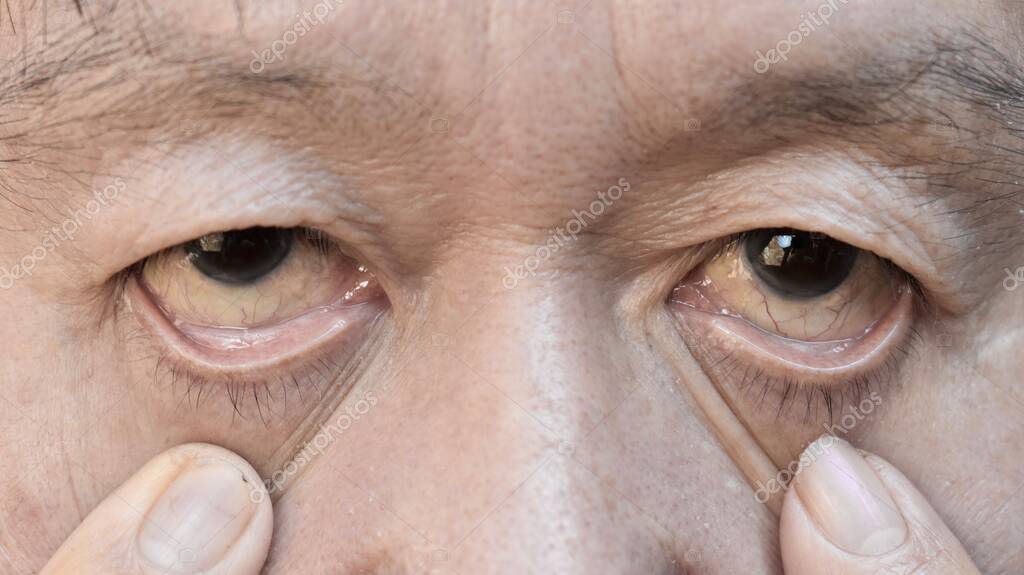 Piel Pálida Del Anciano Asiático Signo Anemia Palidez Párpado — Foto de ...