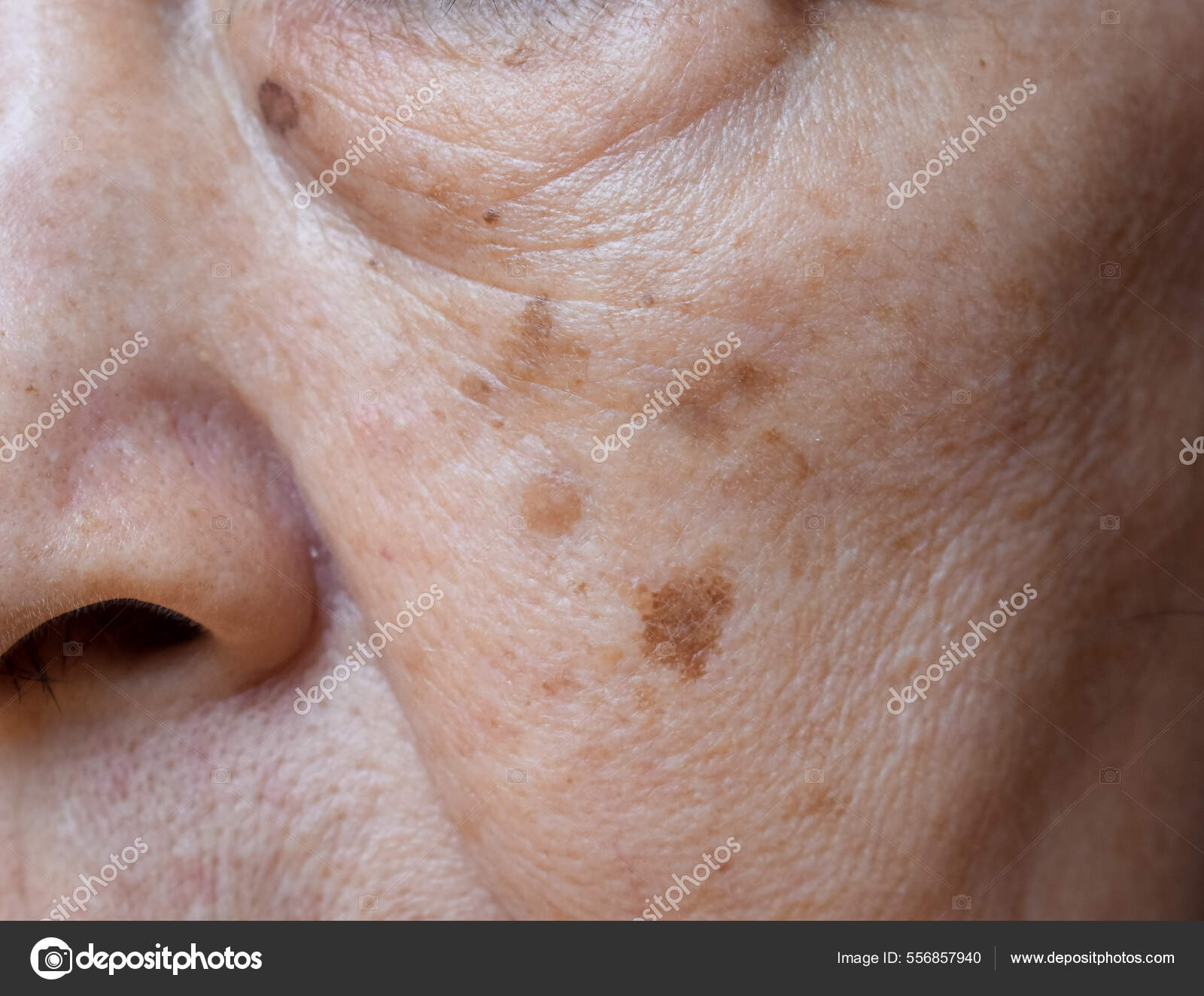 Pequeños Parches Marrones Llamados Manchas Edad Cara Mujer Mayor ...