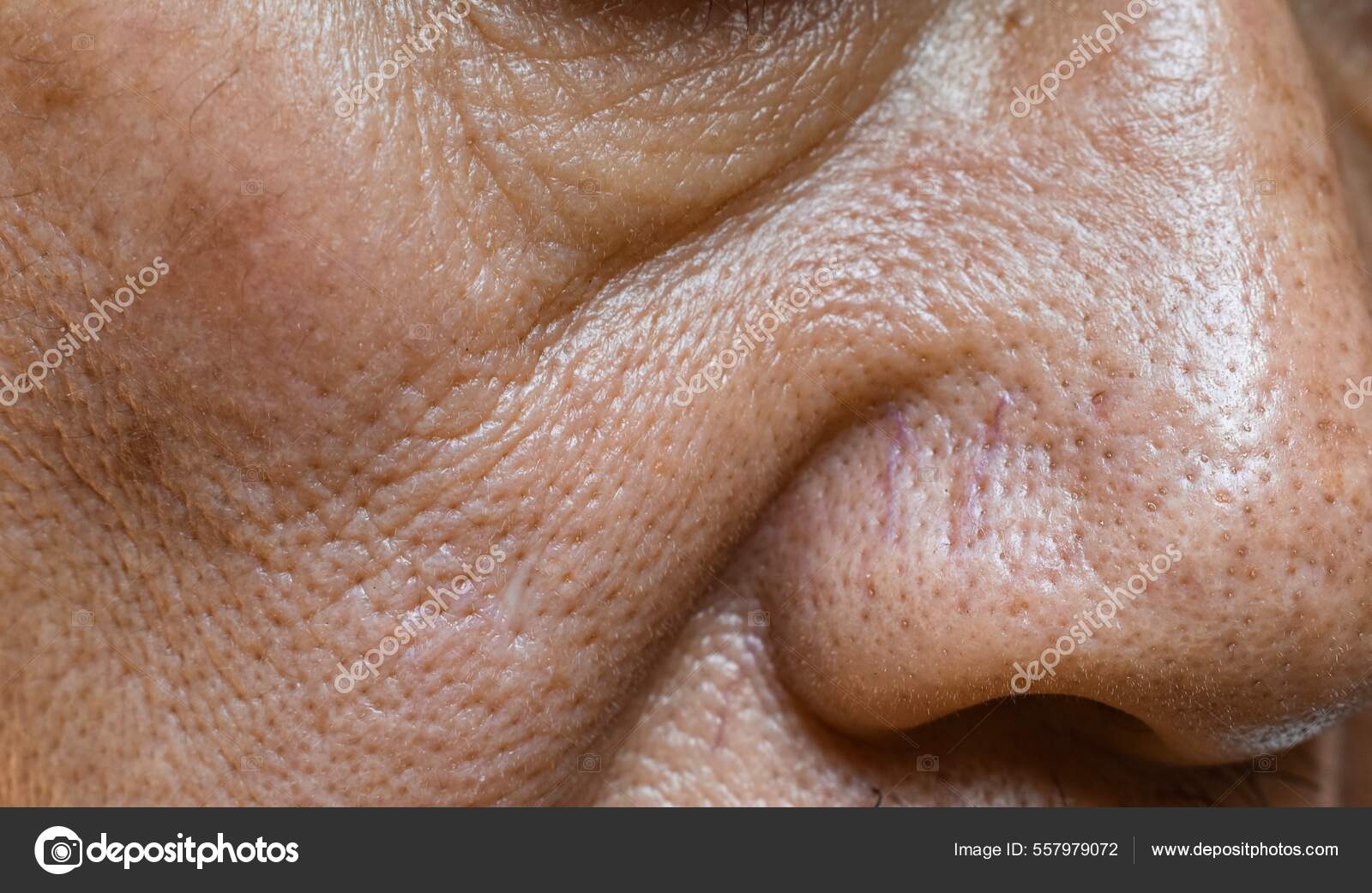 Enlarged Pores Face Southeast Asian Chinese Elder Man — Stock Photo ...