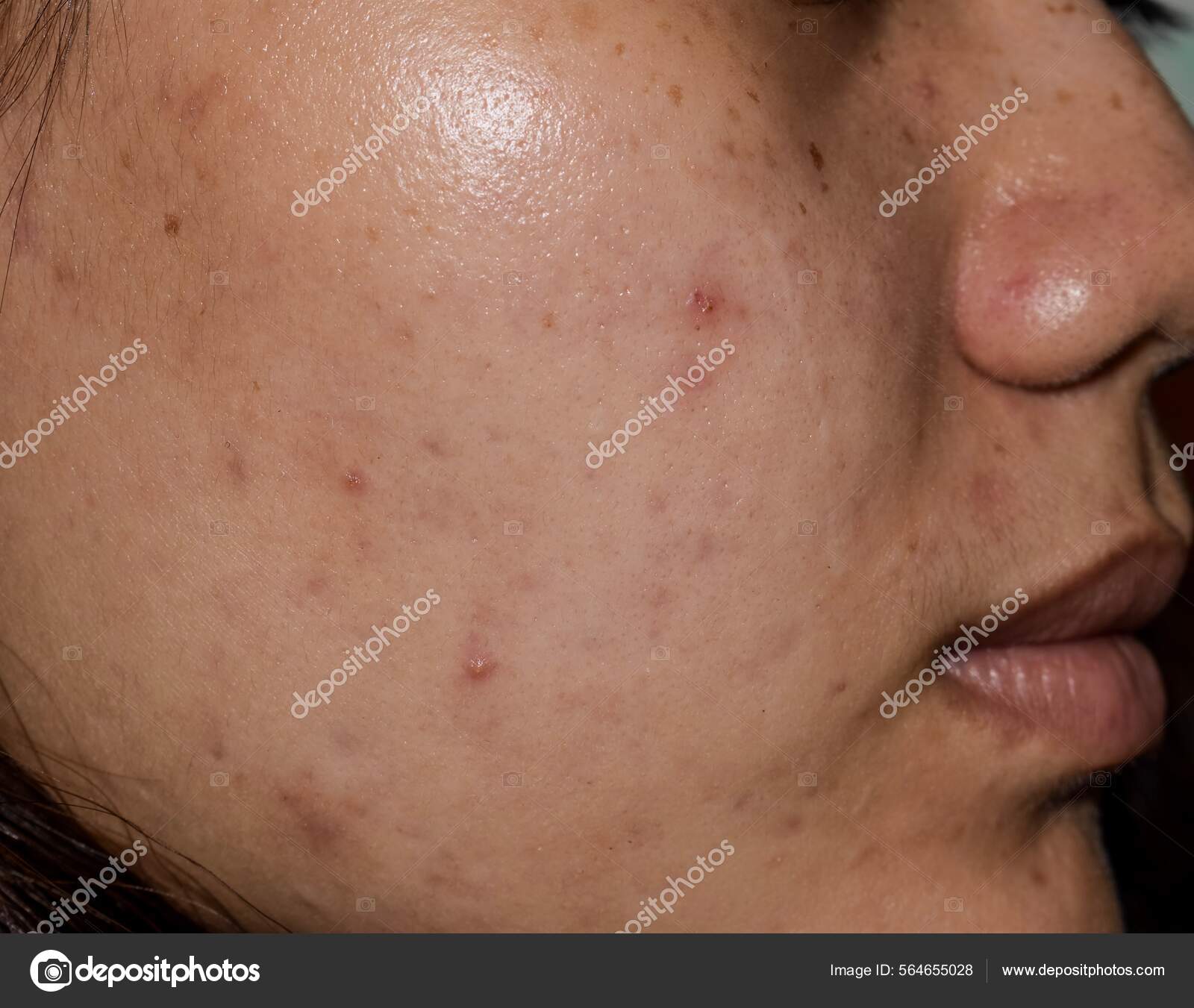 Acne Dark Spots Scars Face Asian Young Woman Stock Photo by ©zaynyinyi ...
