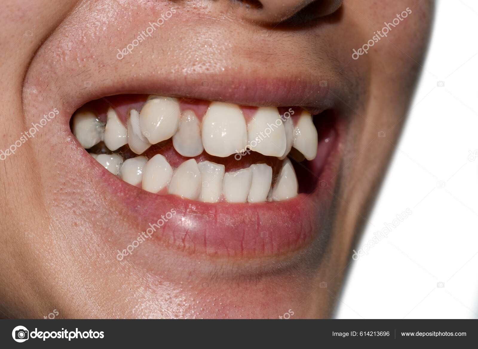 Stacked Overlapping White Teeth Asian Man Also Called Crowded Teeth ...
