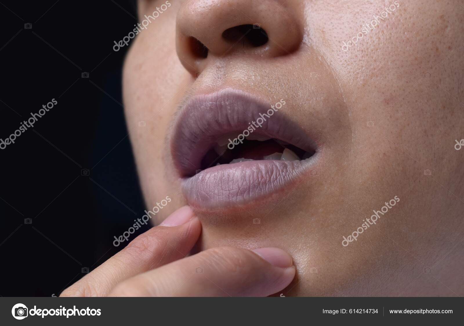 Cyanosis Lips