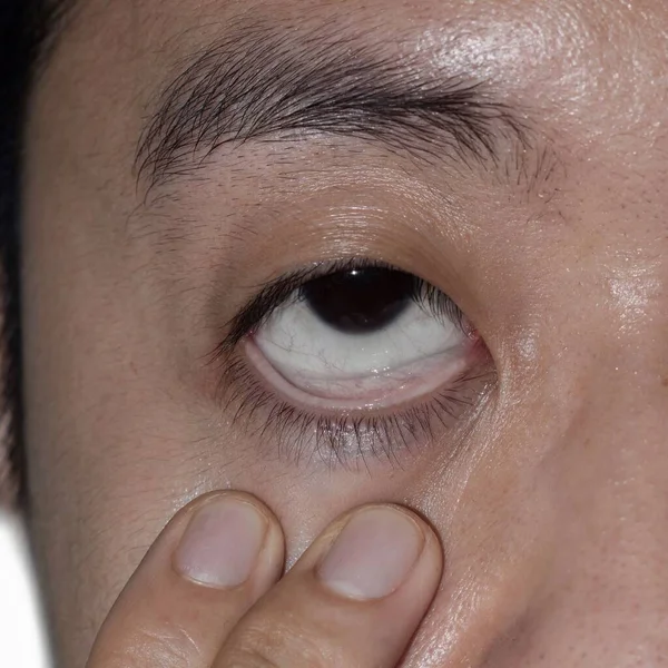 Piel Pálida Del Anciano Asiático Signo Anemia Palidez Párpado — Foto de ...