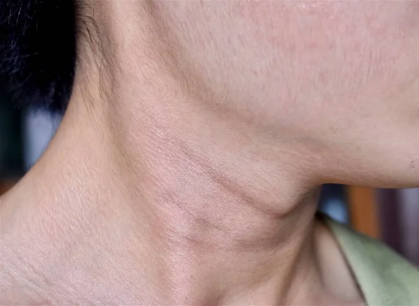 Bumps On Neck
