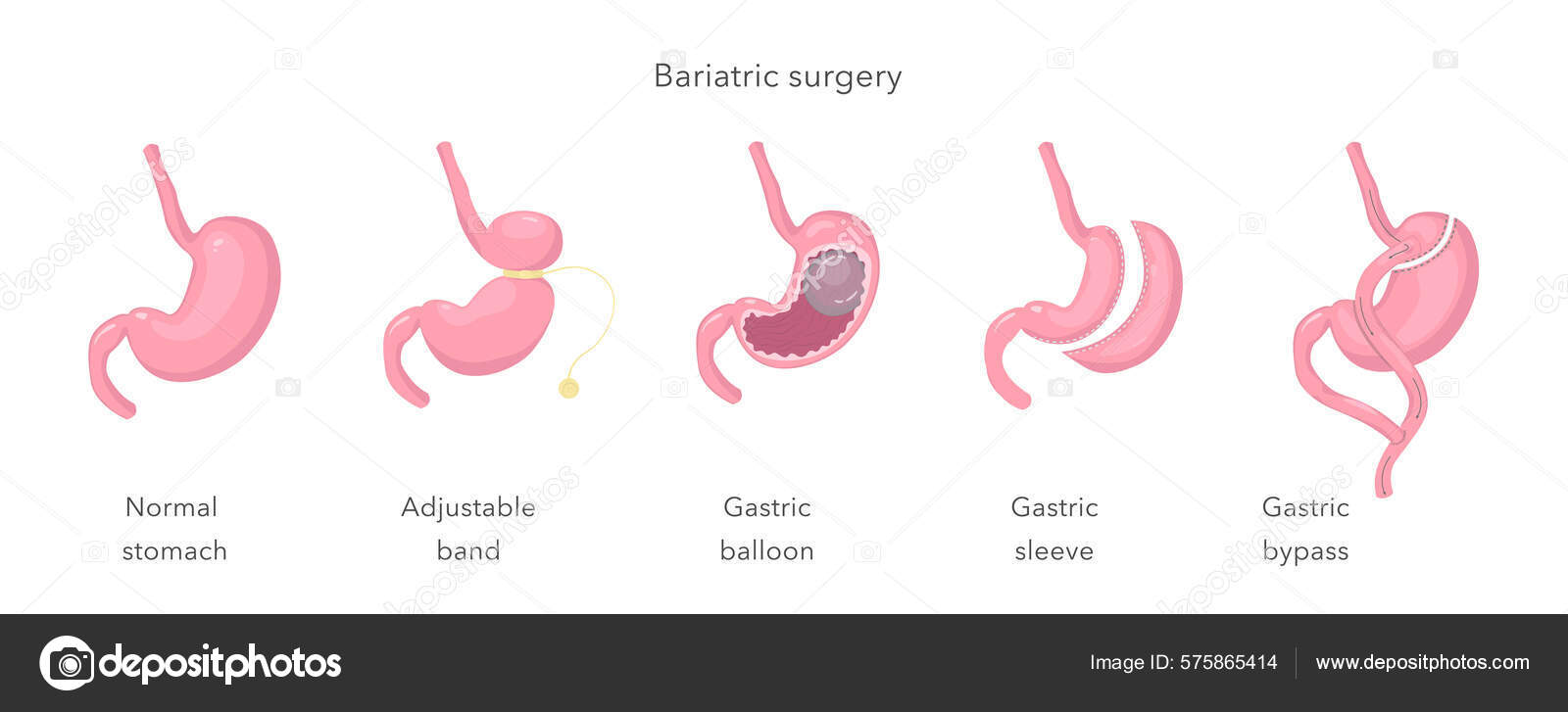 Gastric Bypass Stomach Sleeve Balloon Band Methods Weight Loss Surgery ...