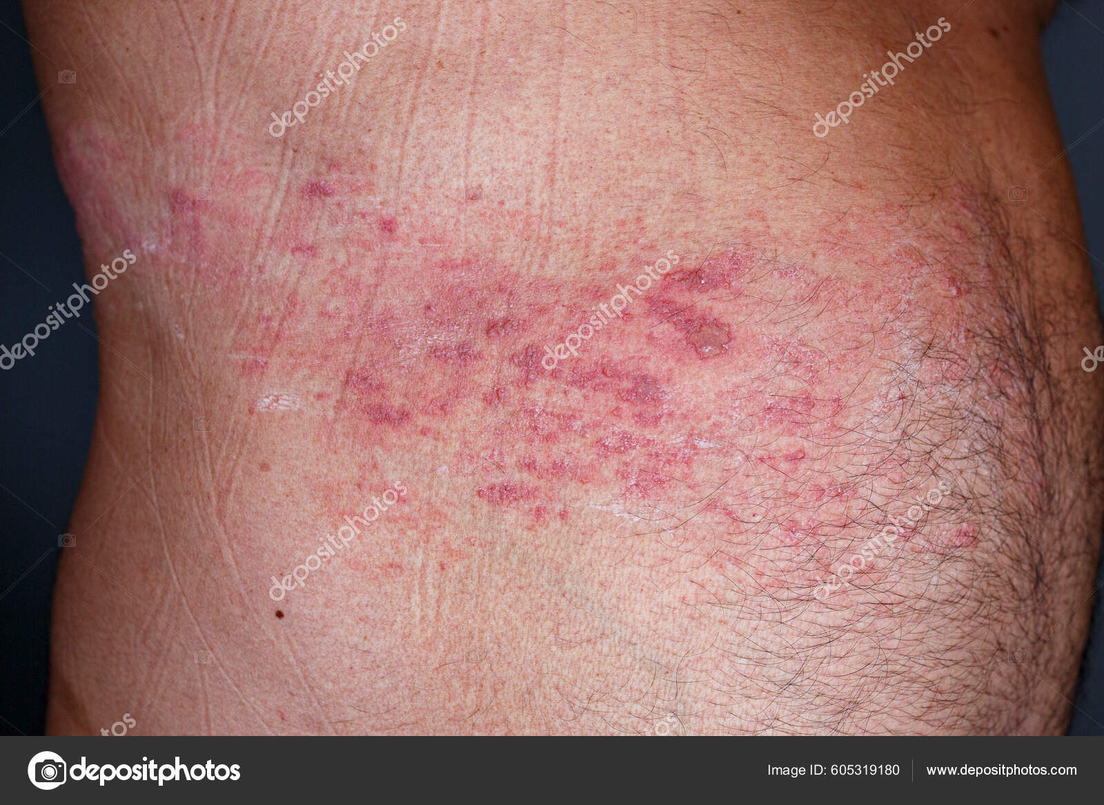 Skin Lesion Symptom Shingles Herpes Zoster Human Shingles Herpes Zoster ...