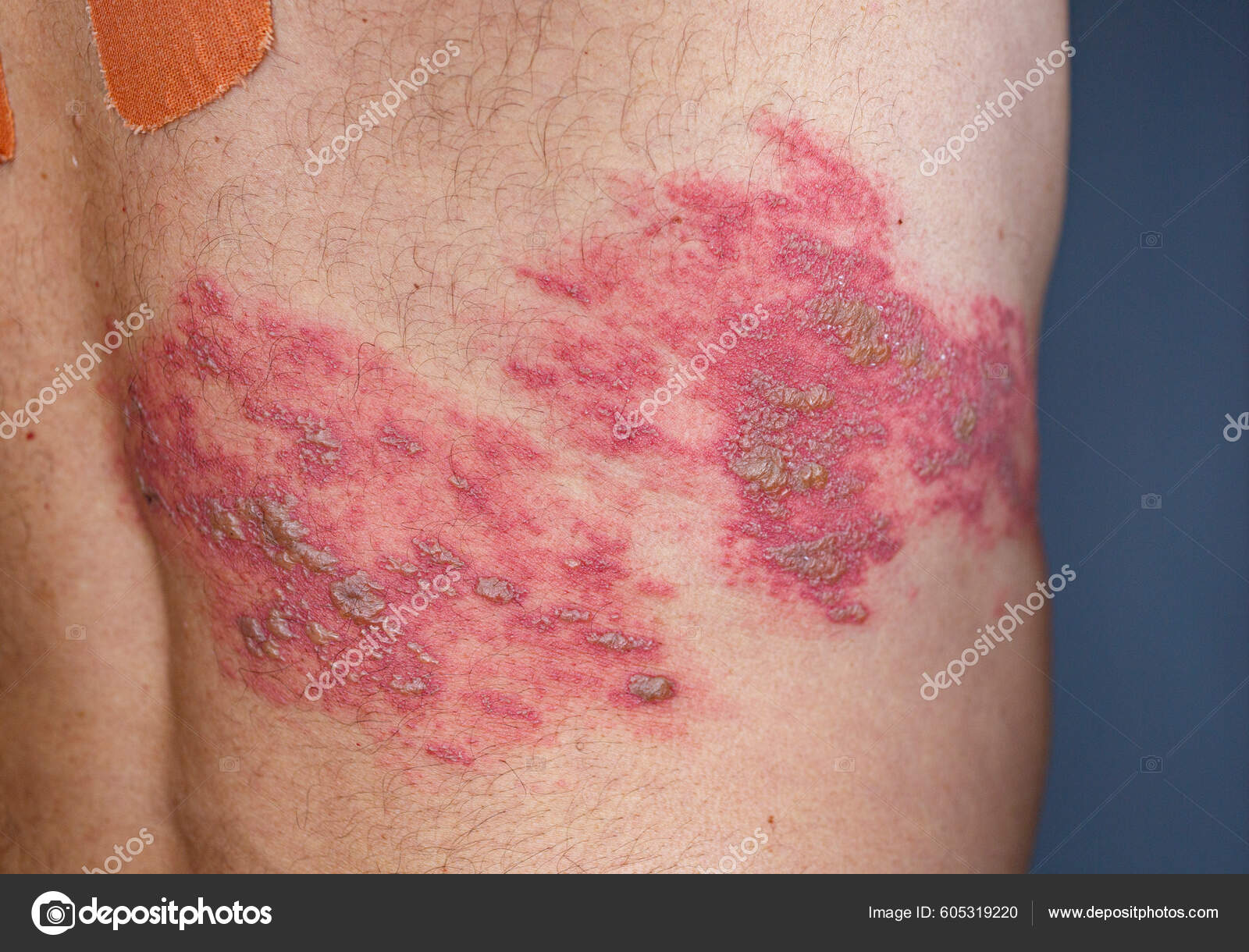 Skin Lesion Symptom Shingles Herpes Zoster Human Shingles Herpes Zoster ...