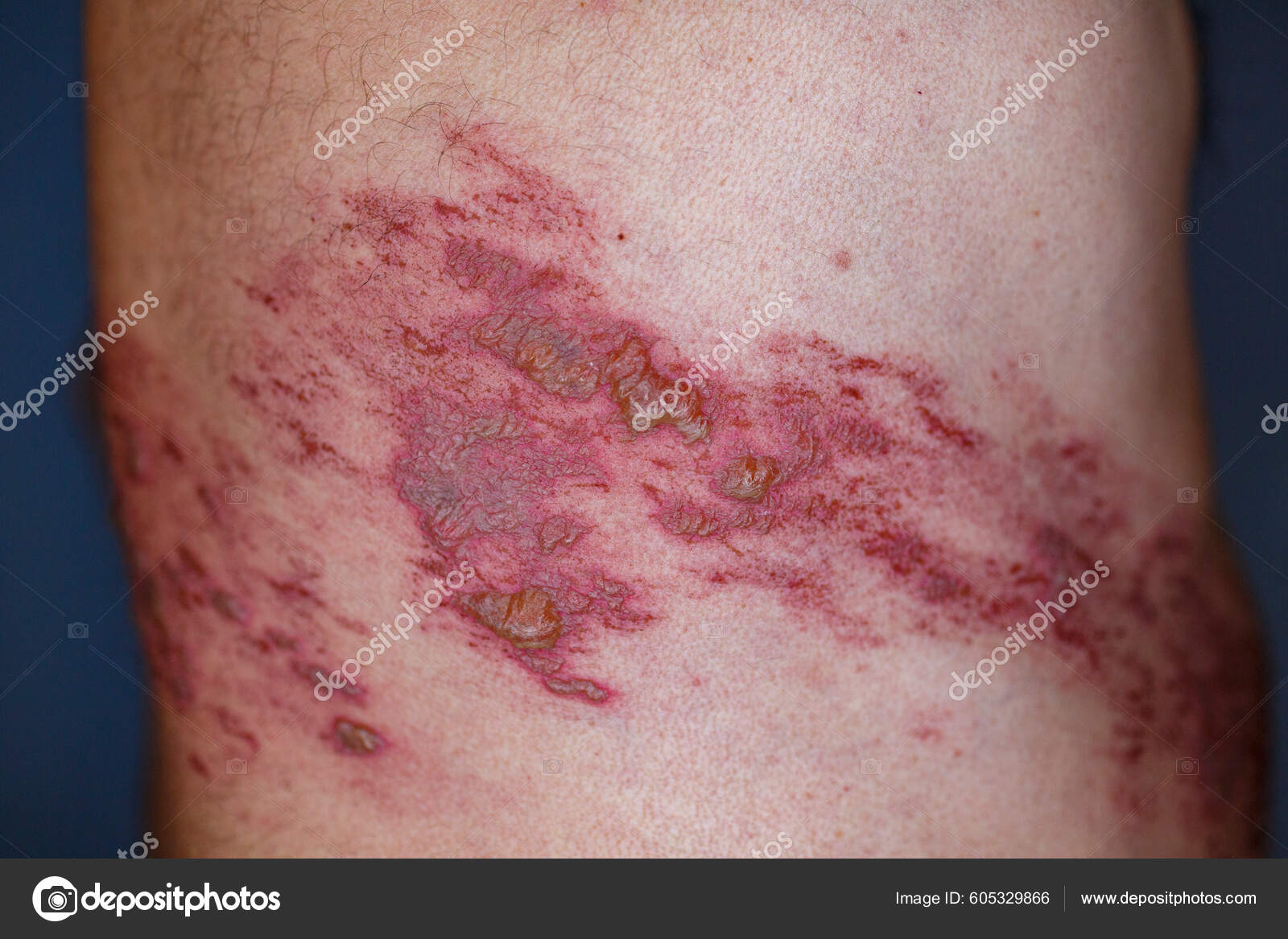 Skin Lesion Symptom Shingles Herpes Zoster Human Shingles Herpes Zoster ...