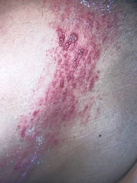 Skin Lesion Symptom Shingles Herpes Zoster Human Shingles Herpes Zoster ...