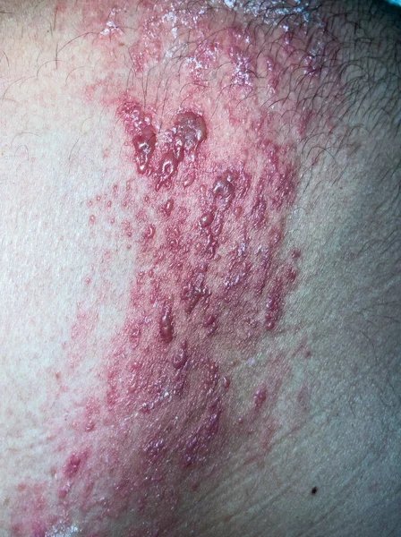 Skin Lesion Symptom Shingles Herpes Zoster Human Shingles Herpes Zoster ...