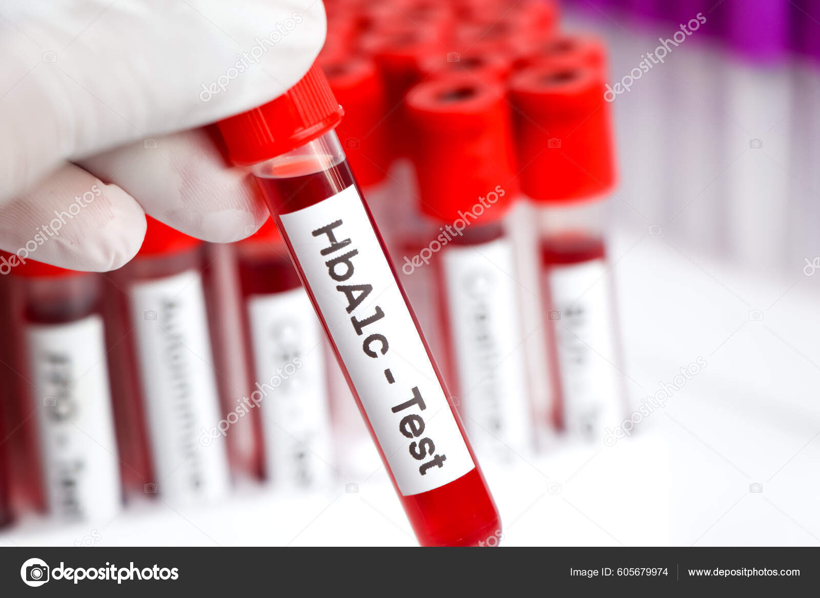 Hba1C Test Blood Blood Samples Analyzed Laboratory Red Blood Test ...