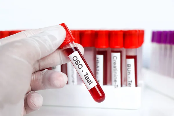 Hba1C Test Blood Blood Samples Analyzed Laboratory Red Blood Test ...