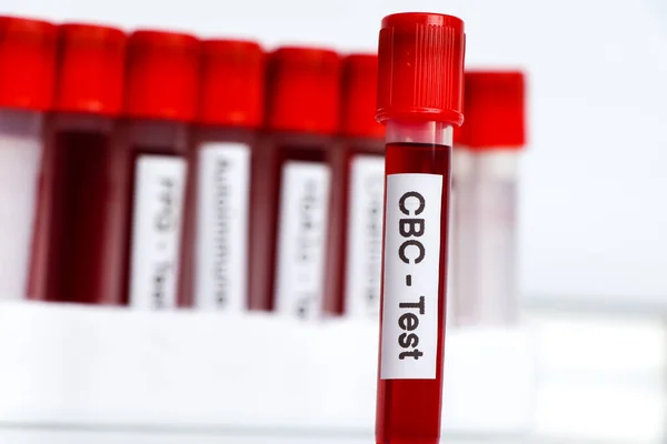 CBC test for abnormalities in red blood cells, Blood samples to be ...