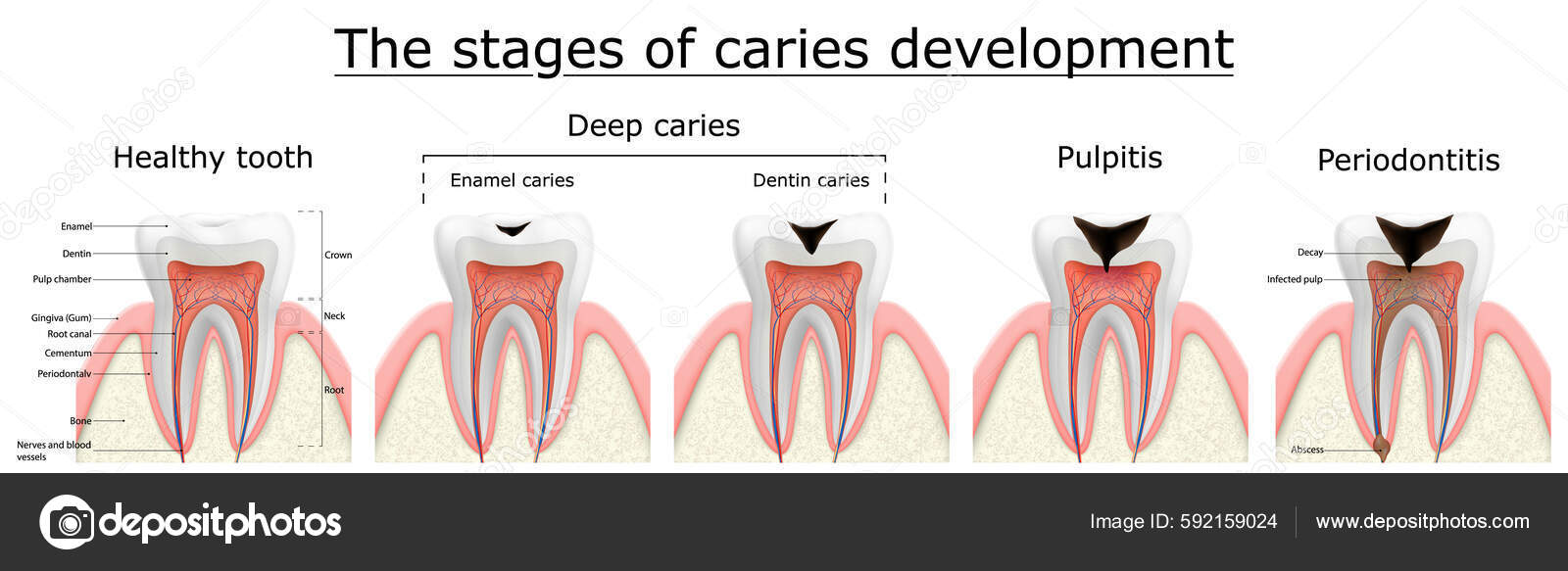 Stages Caries Development Dental Disease Caries Pulpitis Periodontitis ...