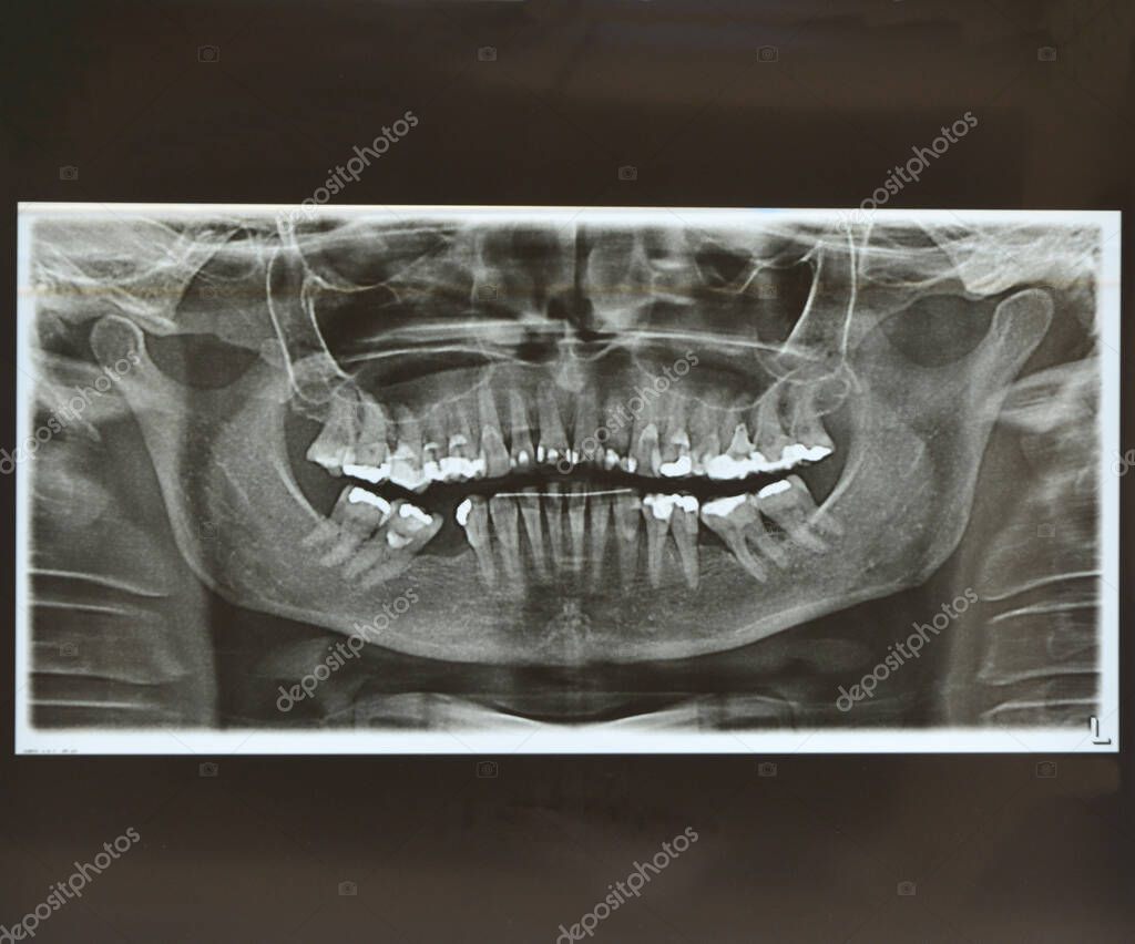 Radiografía dental panorámica de un diente de mujer de cincuenta años ...