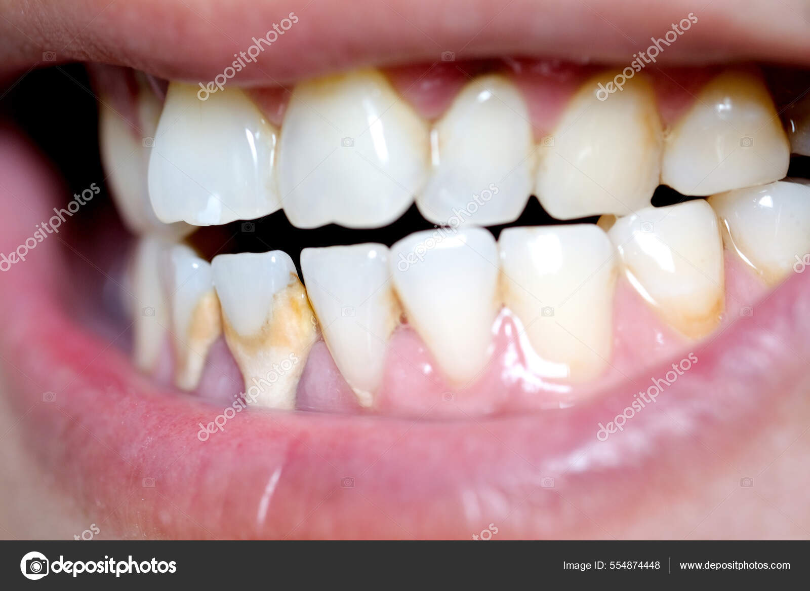 Cigarette Smokers Teeth