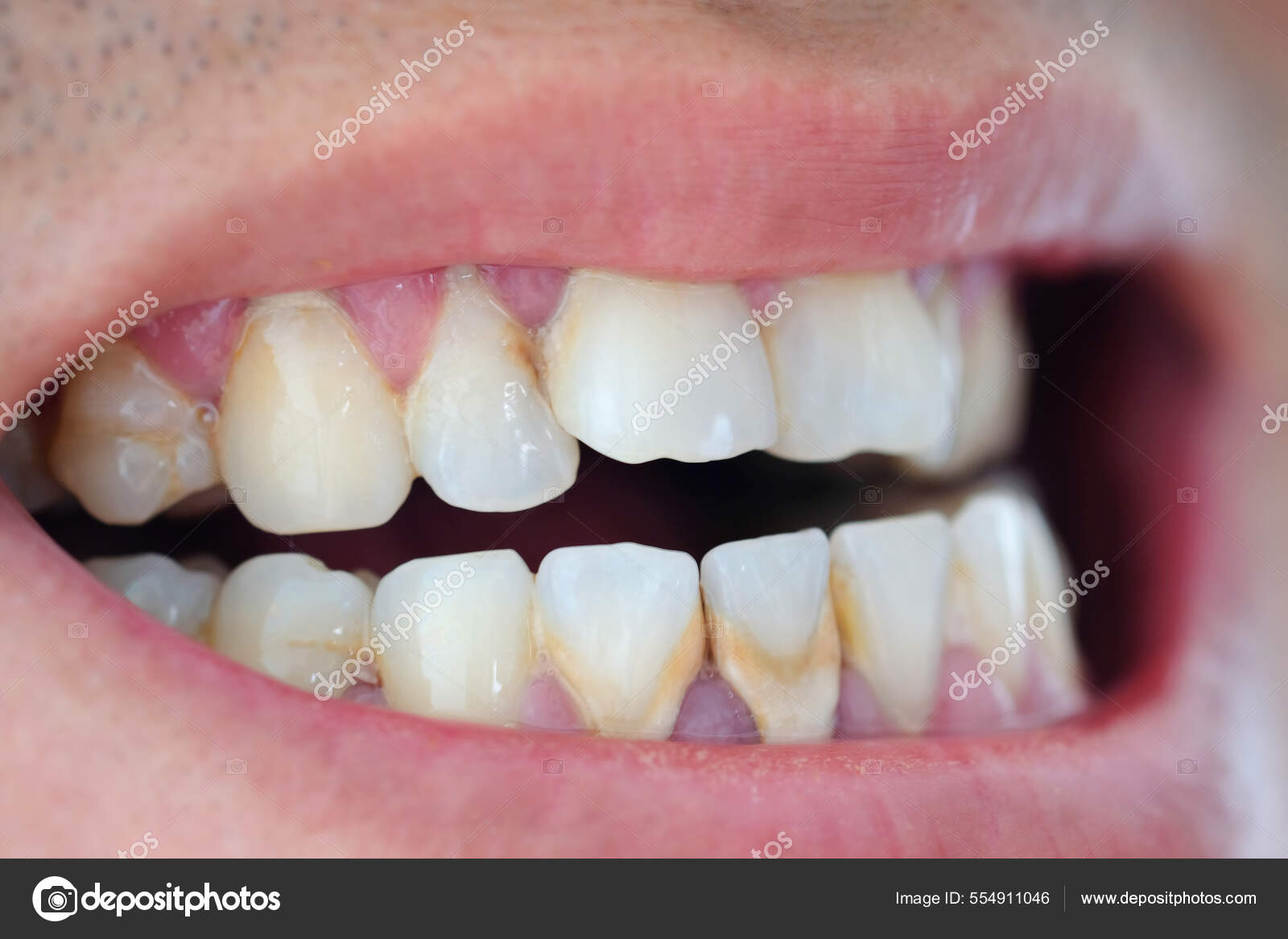 Tooth's Man Smoking Bad Man Smokes Cigarettes Have Tooth Decay Stock ...