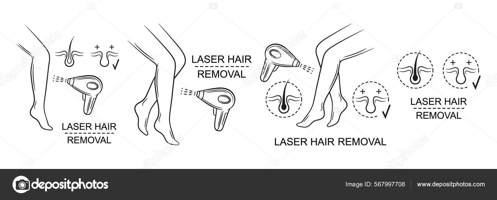 Image vectorielle Laser Hair Removal Woman Legs Epilation Procedure ...